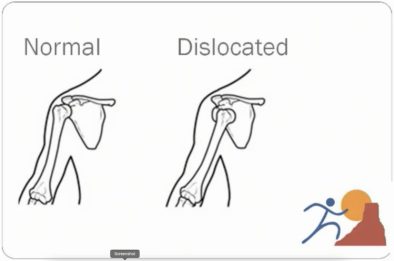 Diagnosing and Treating Shoulder Instability